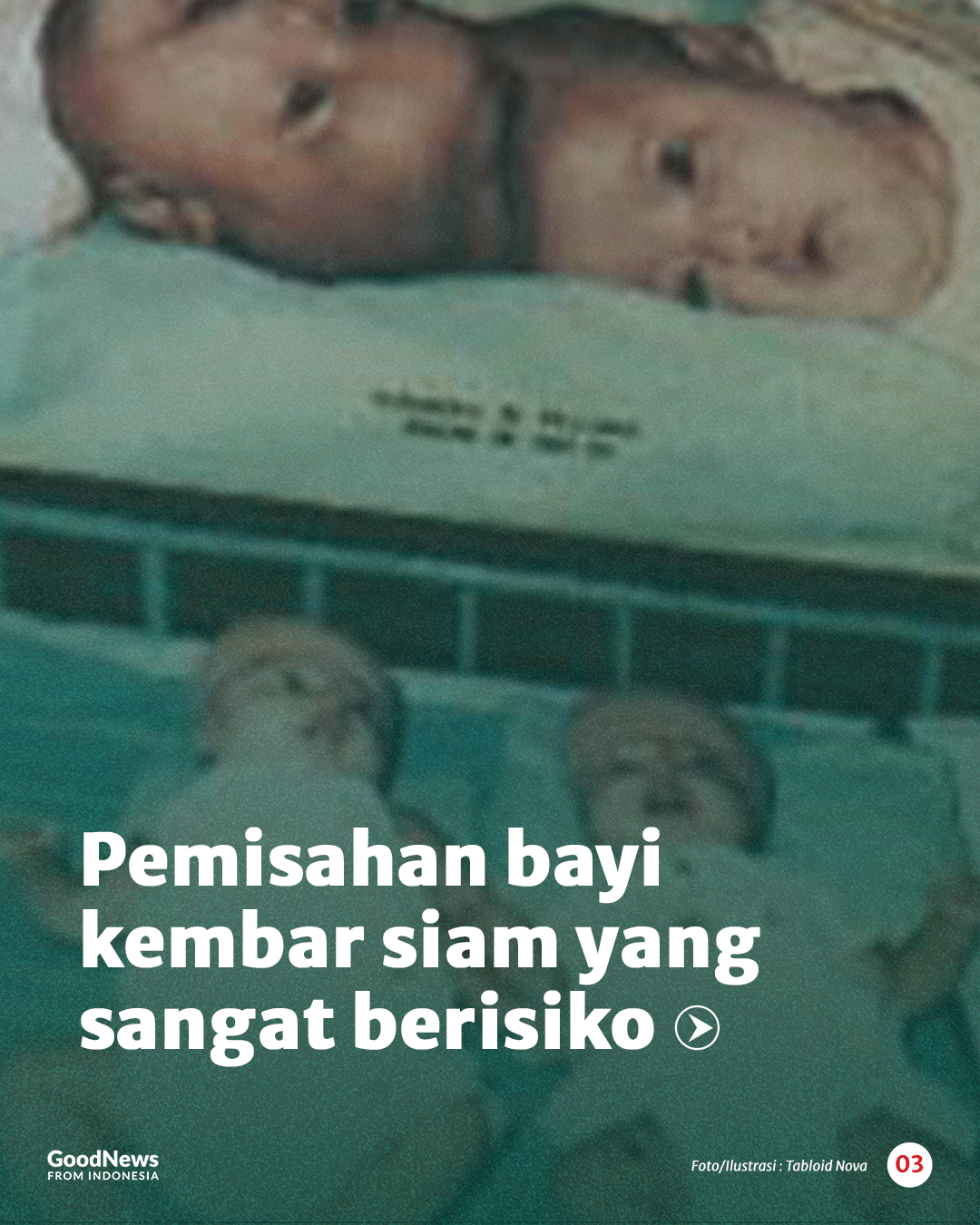 Kisah Dokter Padmosantjojo dan Operasi Bayi Kembar Siam Dempet Kepala ...