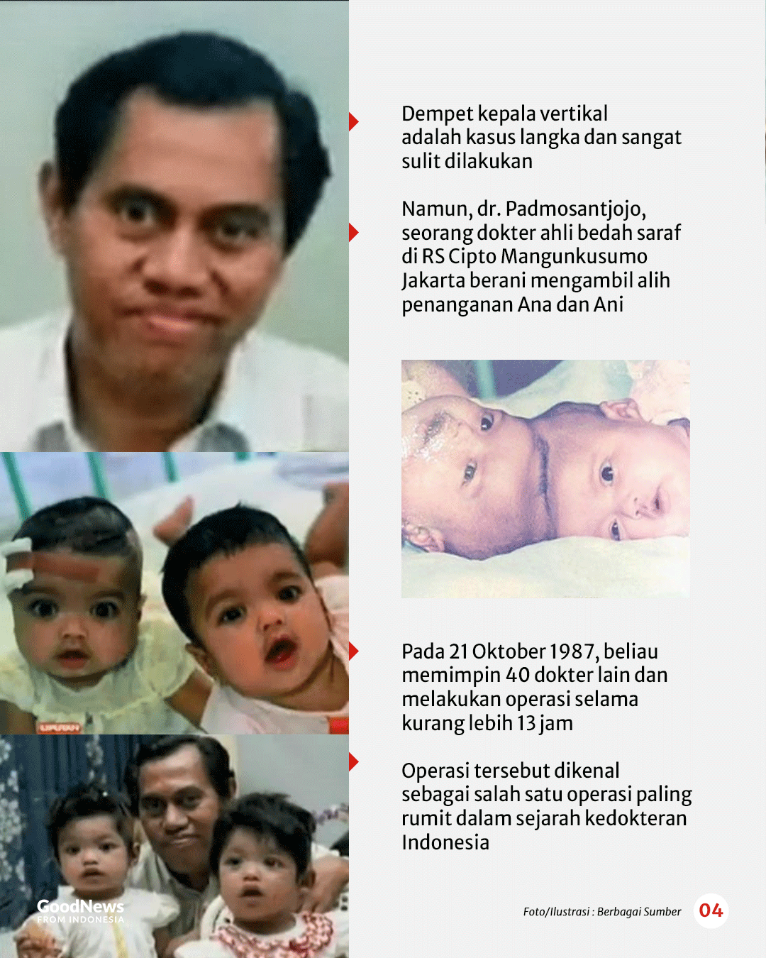 Kisah Dokter Padmosantjojo dan Operasi Bayi Kembar Siam Dempet Kepala Pertama di Indonesia